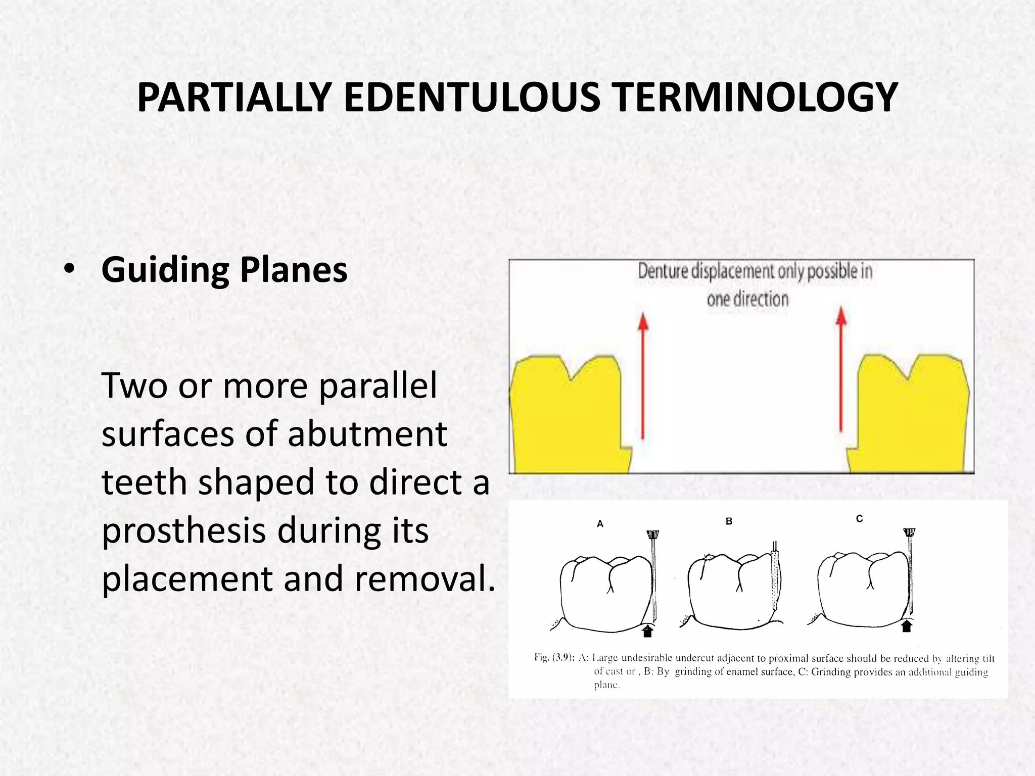 2nd year pre clinical RPD Terminology, Components and Classification of ...