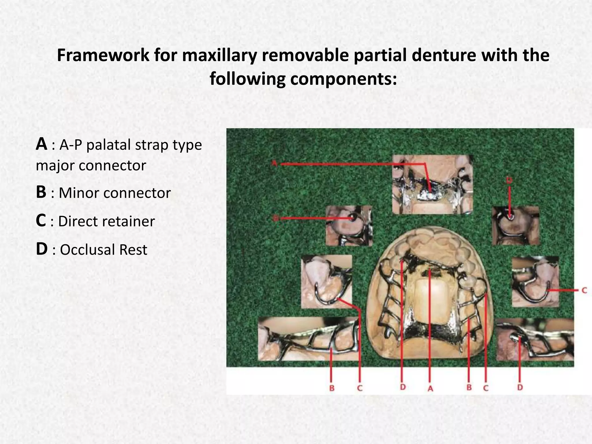 2nd year pre clinical RPD Terminology, Components and Classification of ...