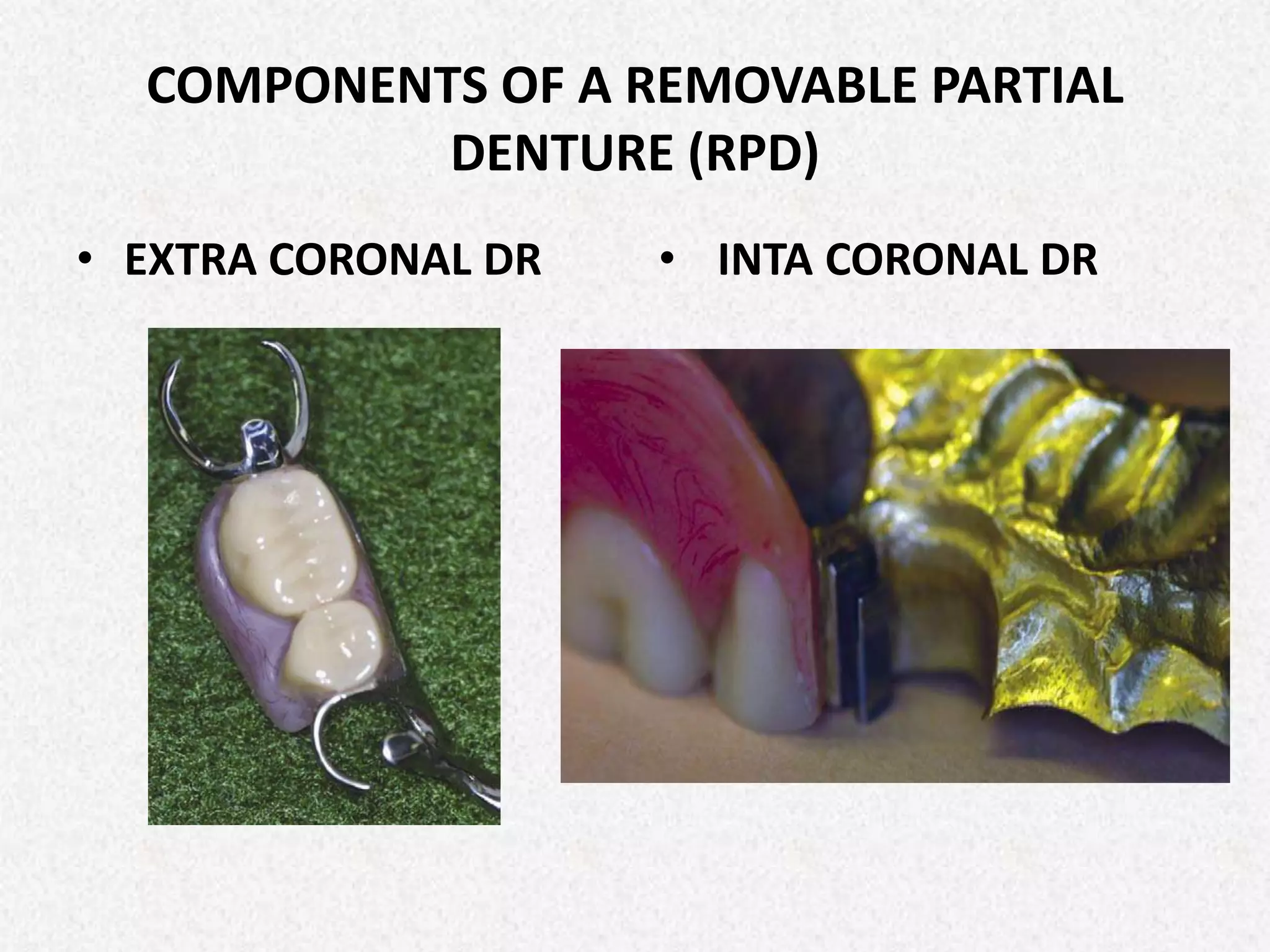 2nd year pre clinical RPD Terminology, Components and Classification of ...