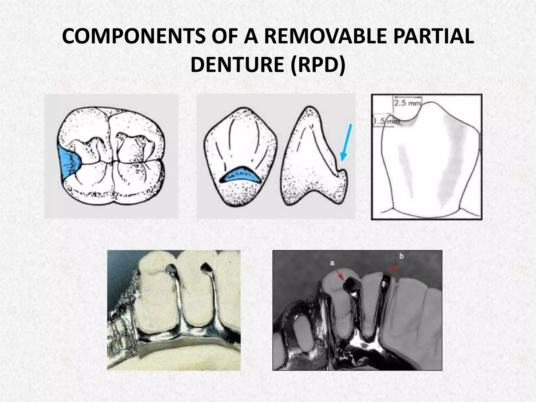 2nd year pre clinical RPD Terminology, Components and Classification of ...