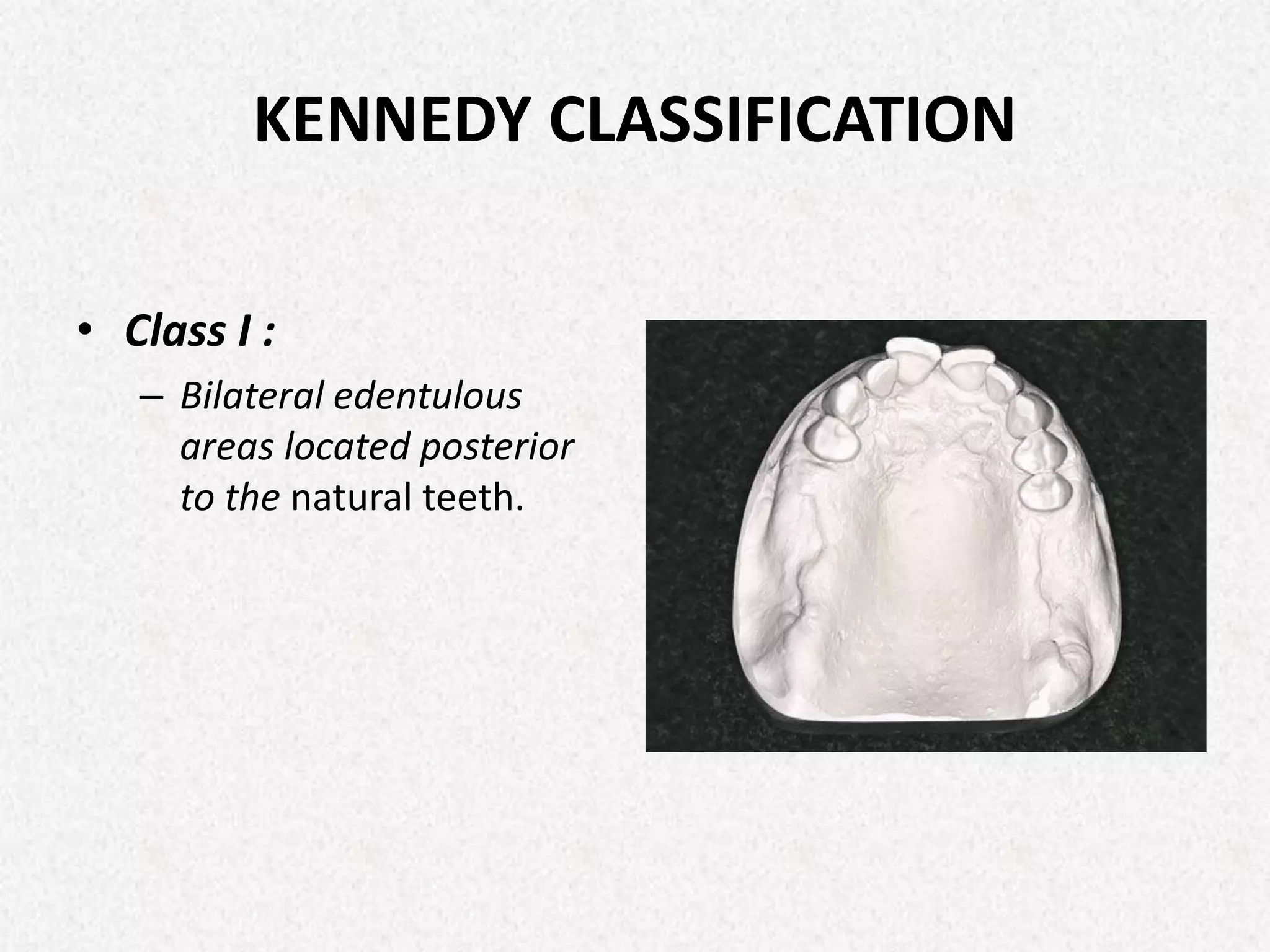2nd year pre clinical RPD Terminology, Components and Classification of ...