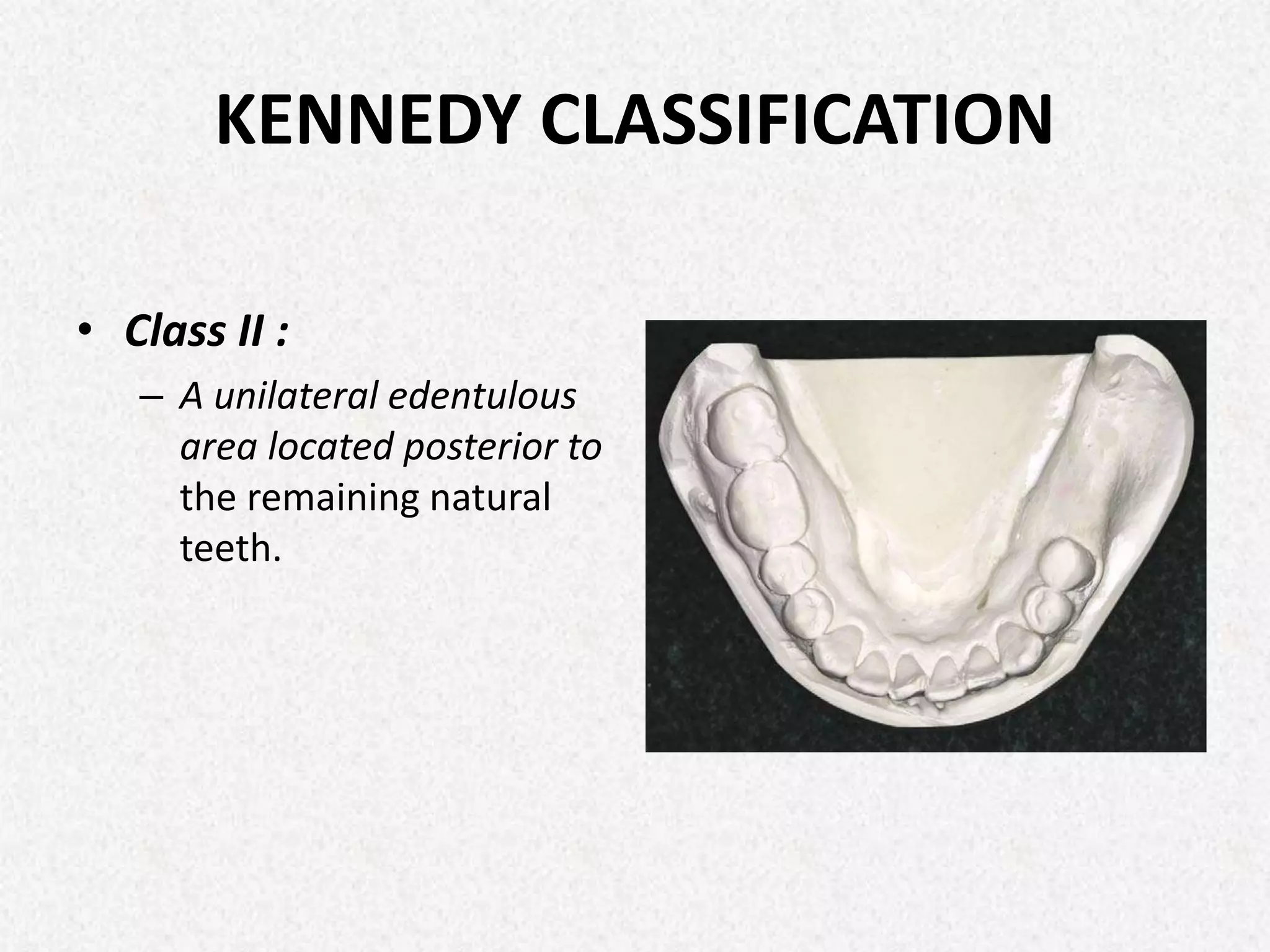 2nd year pre clinical RPD Terminology, Components and Classification of ...