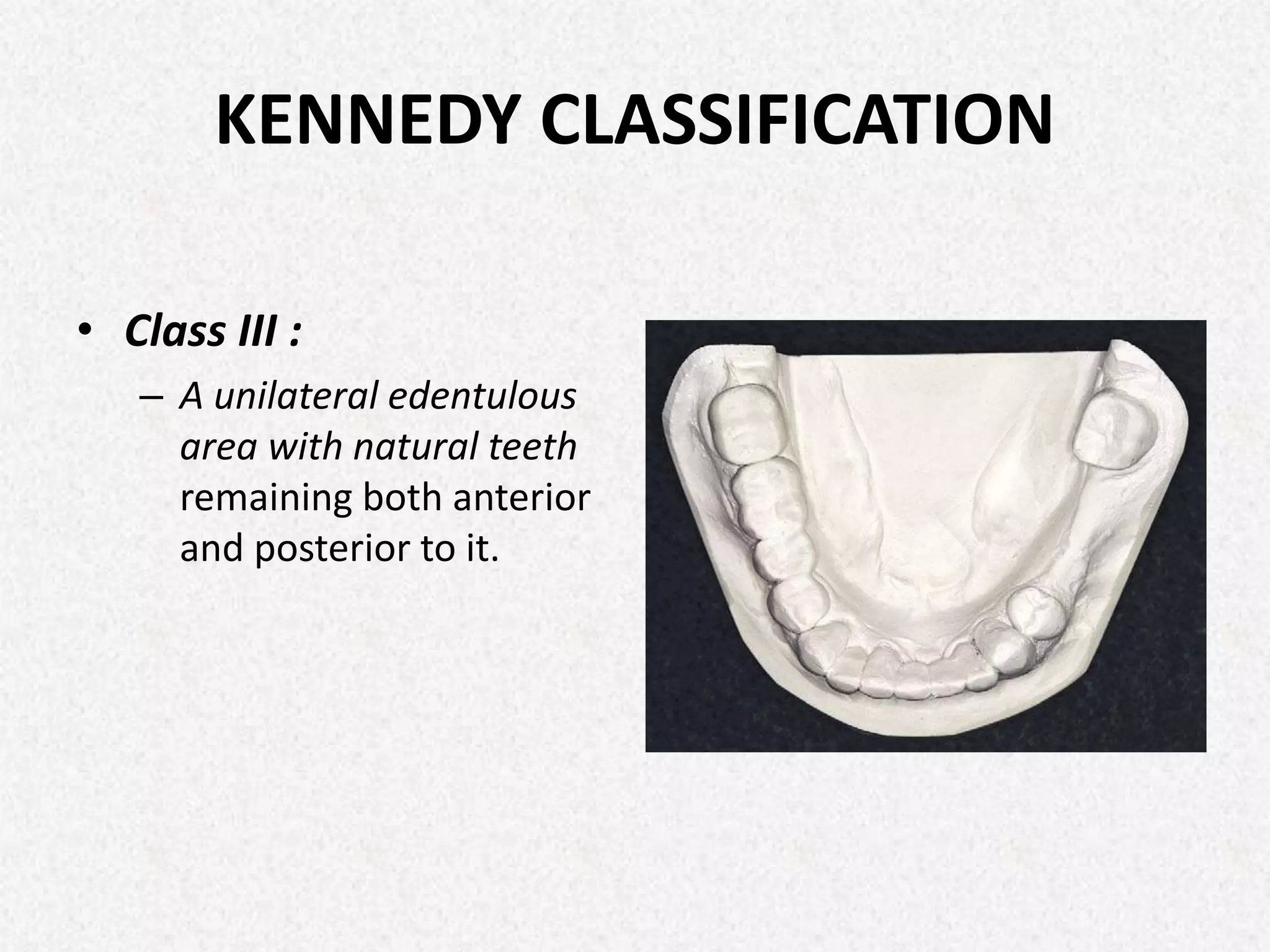 2nd year pre clinical RPD Terminology, Components and Classification of ...