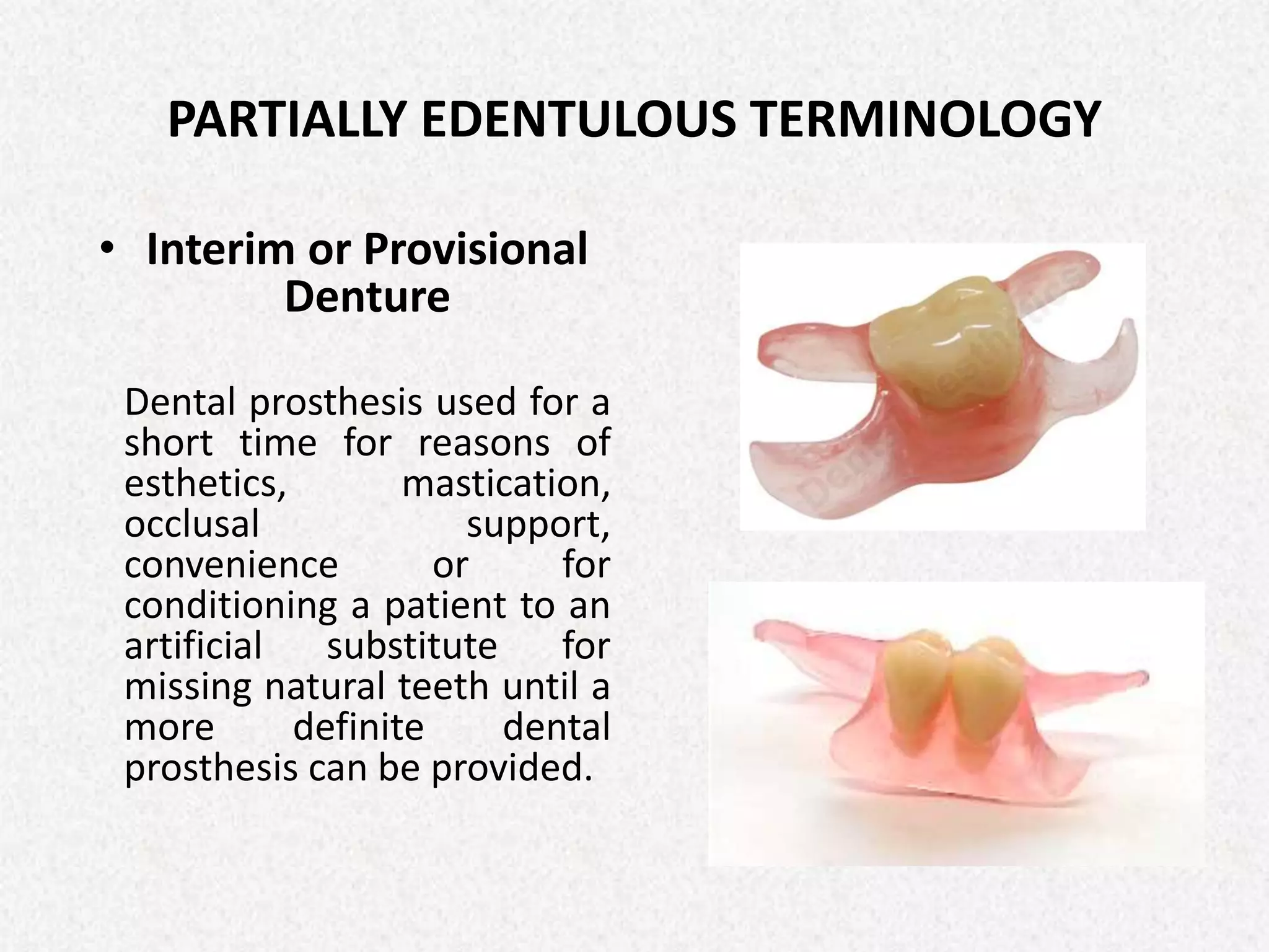 2nd year pre clinical RPD Terminology, Components and Classification of ...