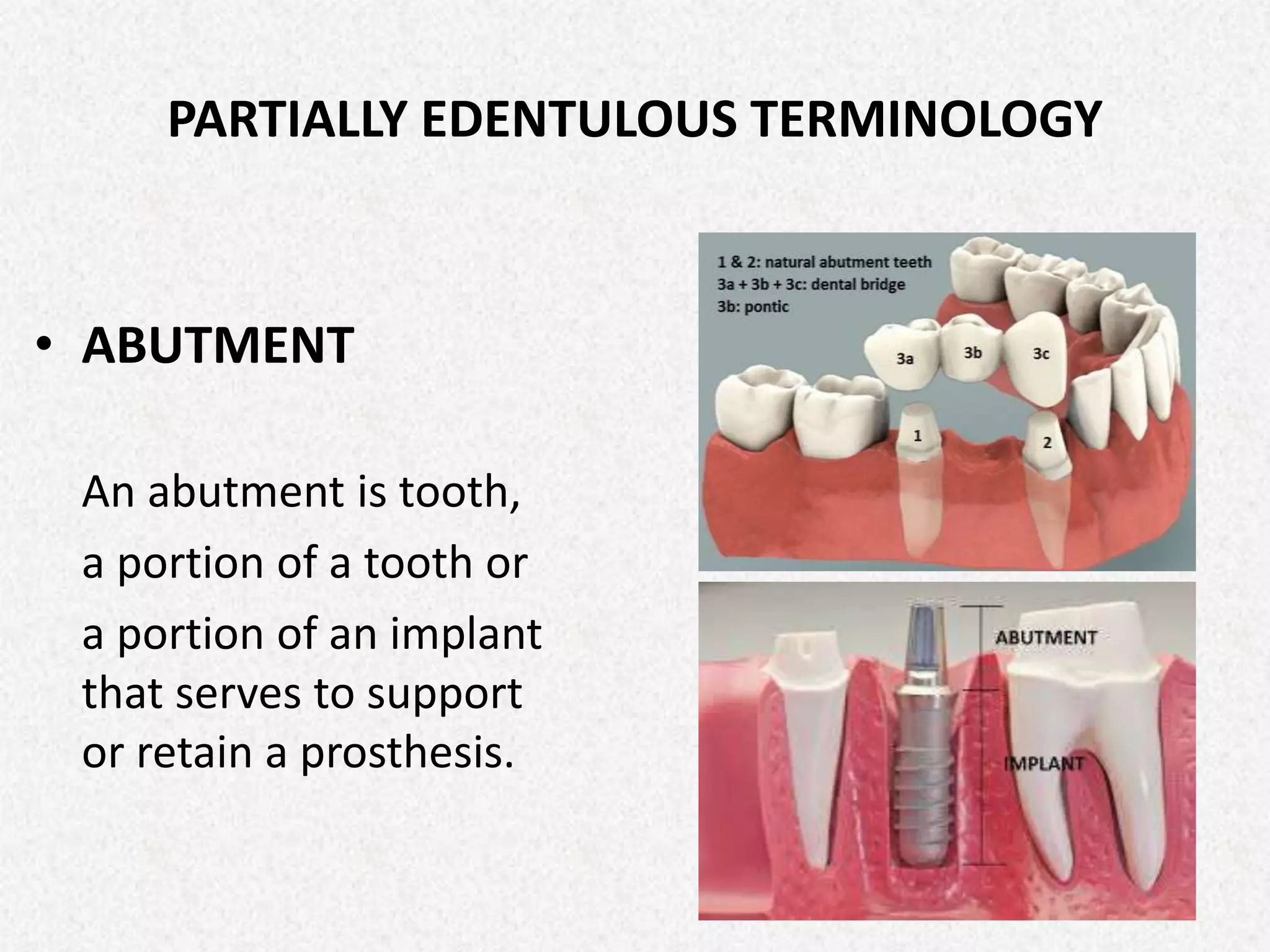 2nd year pre clinical RPD Terminology, Components and Classification of ...