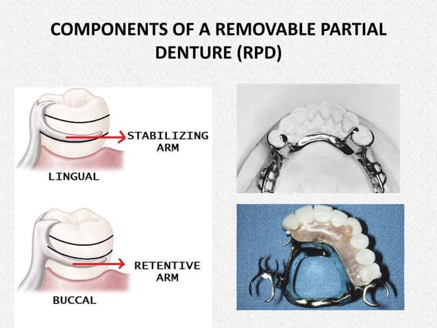 2nd year pre clinical RPD Terminology, Components and Classification of ...