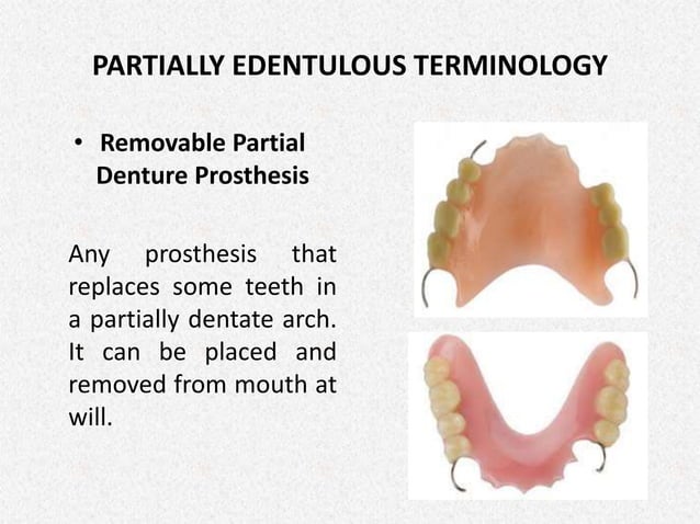 2nd year pre clinical RPD Terminology, Components and Classification of ...