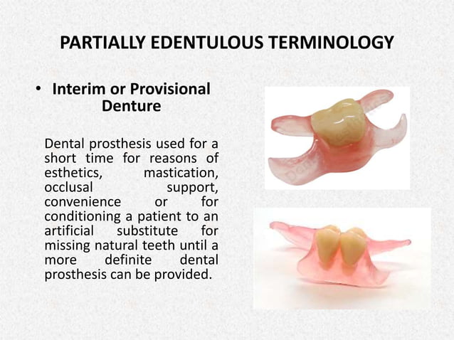 2nd year pre clinical RPD Terminology, Components and Classification of ...