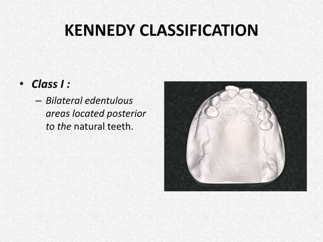 2nd year pre clinical RPD Terminology, Components and Classification of ...