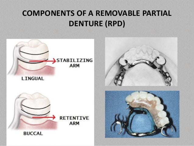 2nd year pre clinical RPD Terminology, Components and Classification