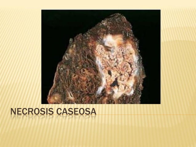 2 necrosis caseosa | PPT