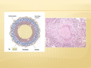 2 necrosis caseosa | PPT
