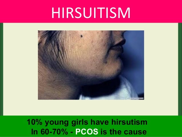 HYPER - ANDROGENISM: UPDATE OF DIAGNOSIS , Dr. Sharda Jain Dr. Jyoti…