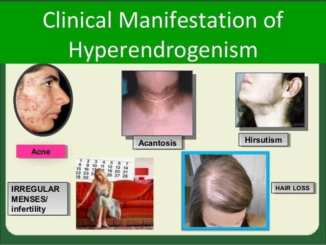 HYPER - ANDROGENISM: UPDATE OF DIAGNOSIS , Dr. Sharda Jain Dr. Jyoti…