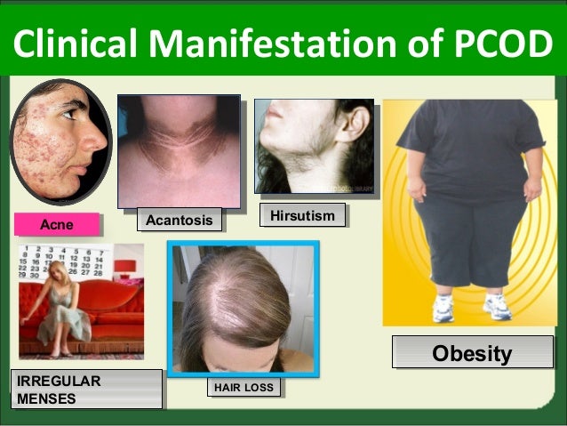 Understanding vHyper-Androgenism: Diagnosis & Managementv“Through Cas…