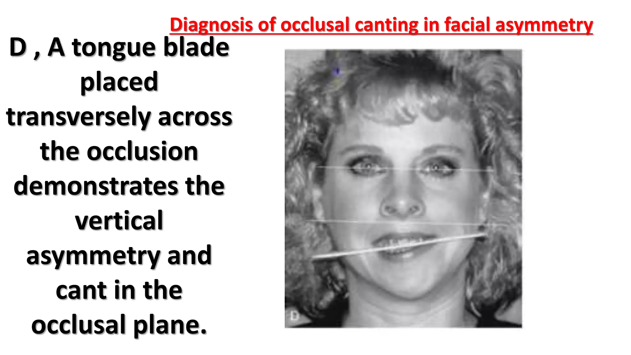 orthodontic correction of canted occlusal plane part 2 | PPTX
