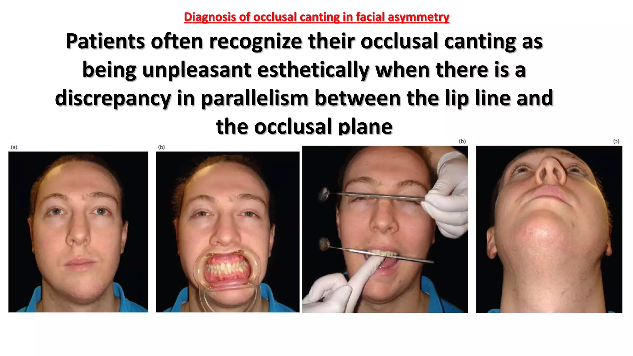 orthodontic correction of canted occlusal plane part 2 | PPTX