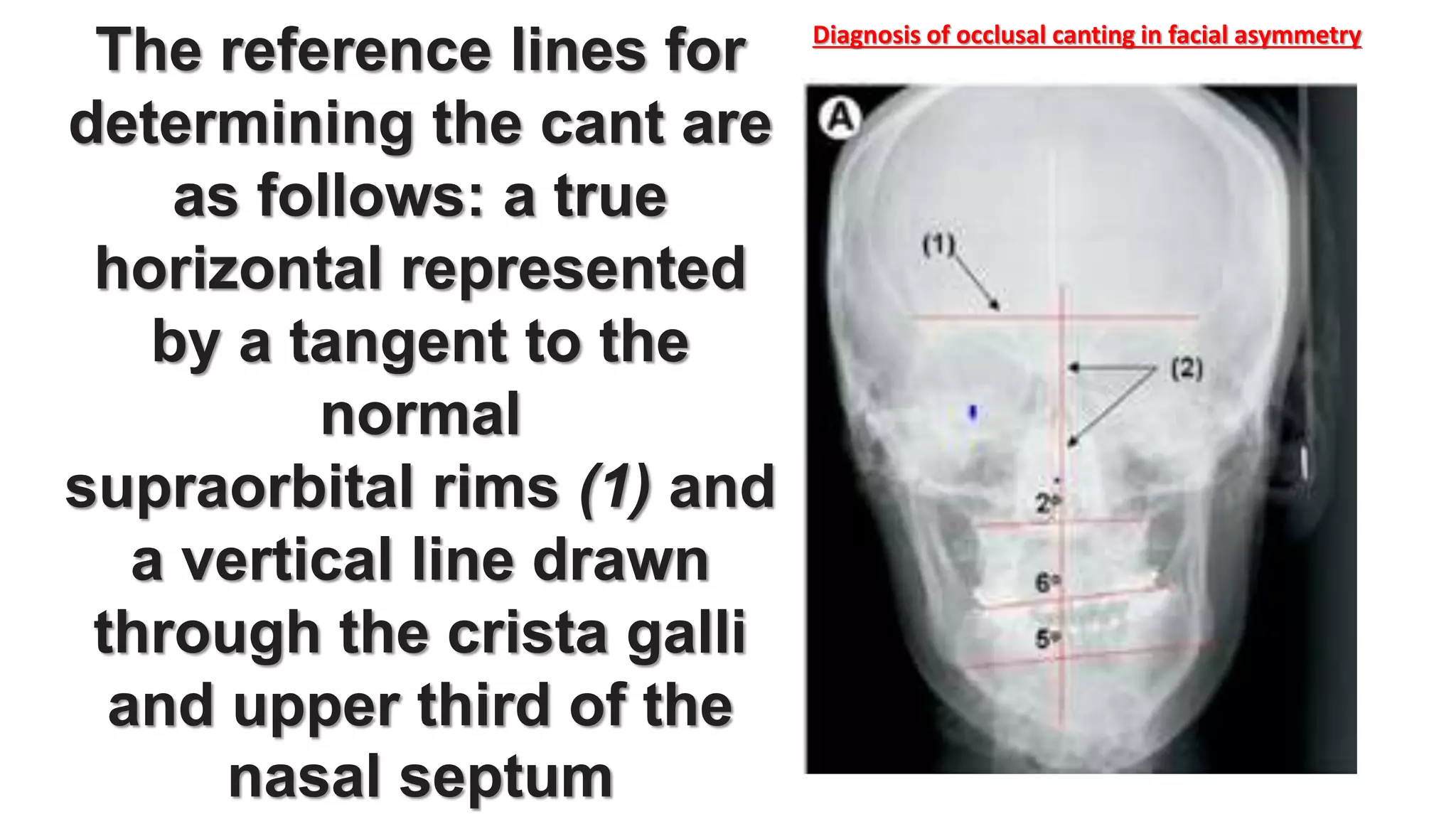 orthodontic correction of canted occlusal plane part 2 | PPTX