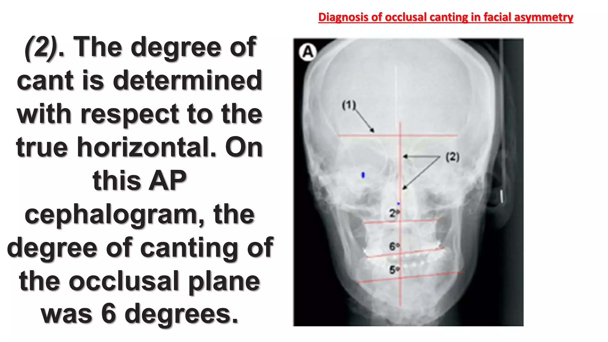 orthodontic correction of canted occlusal plane part 2 | PPTX