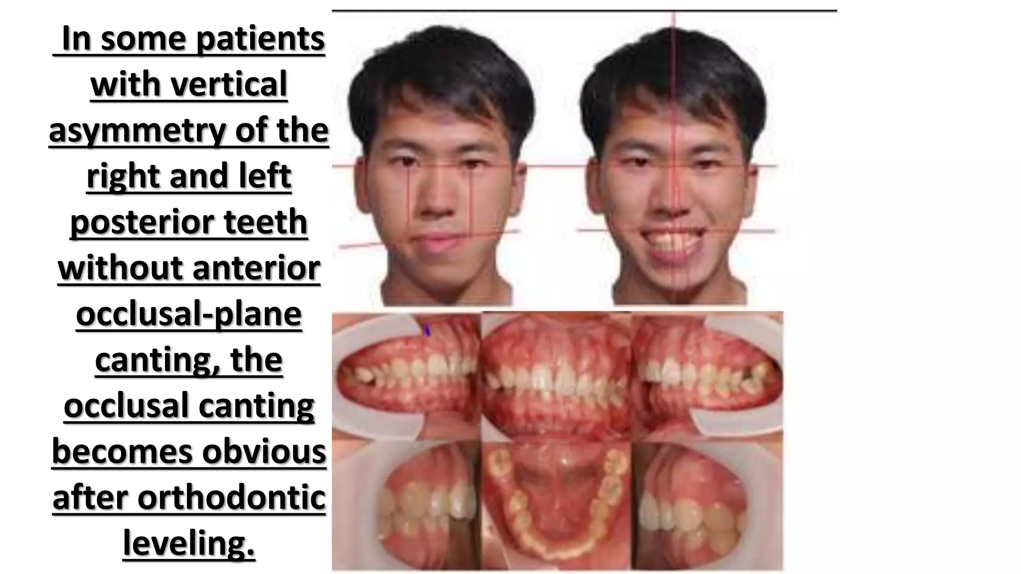 orthodontic correction of canted occlusal plane part 2 | PPTX