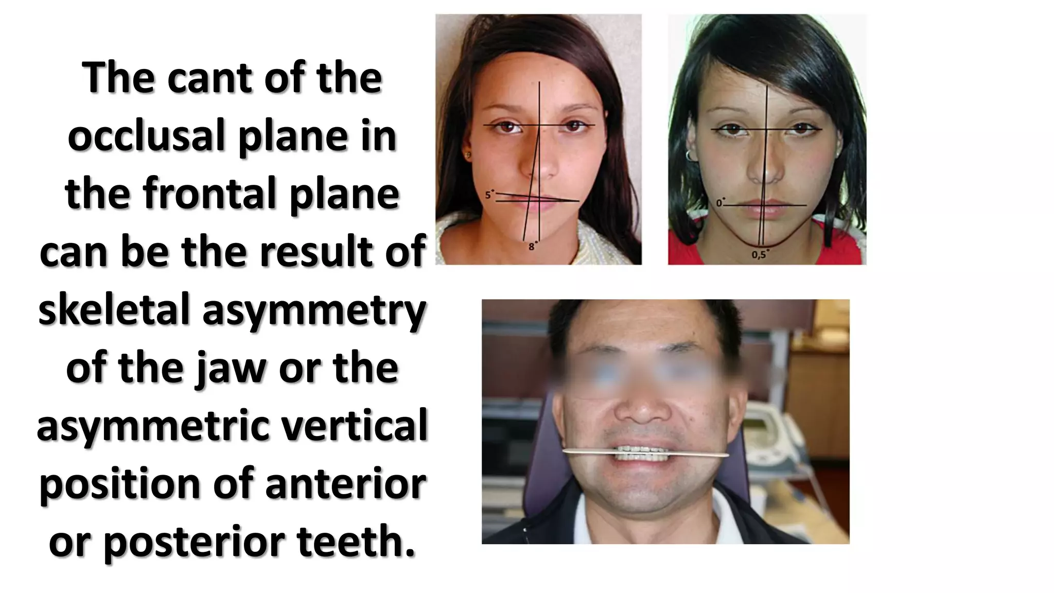 orthodontic correction of canted occlusal plane part 2 | PPTX