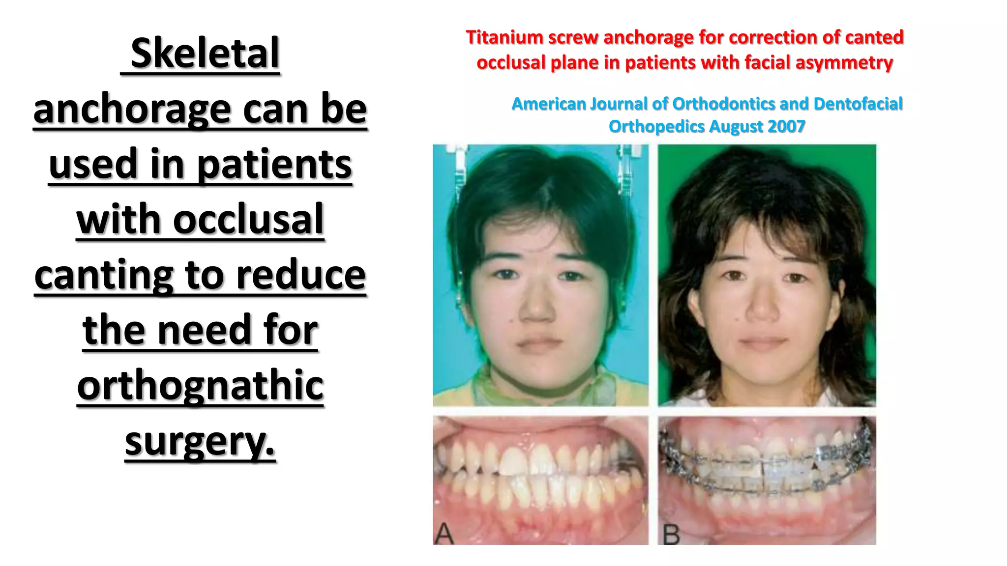 orthodontic correction of canted occlusal plane part 2 | PPTX