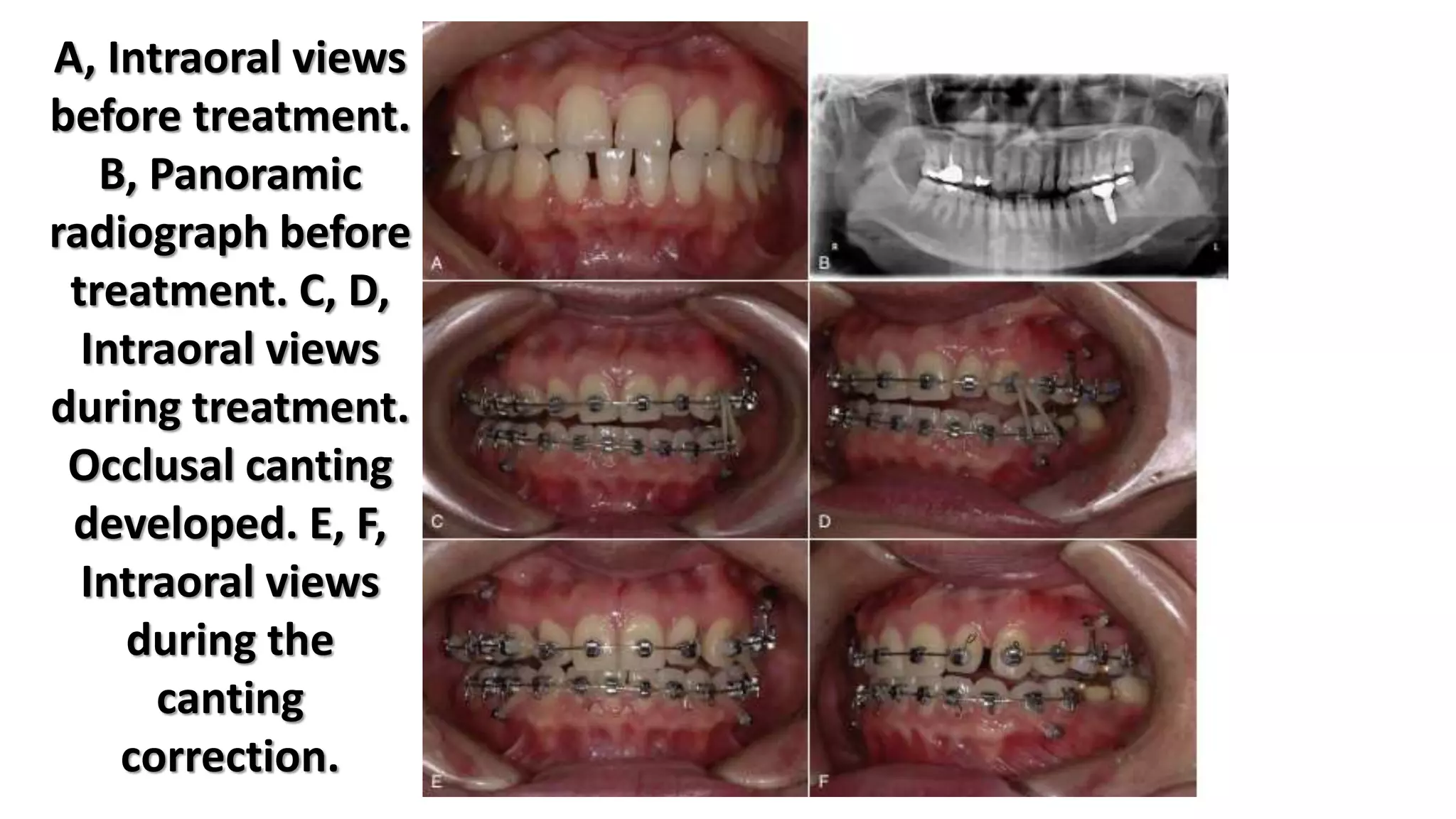 orthodontic correction of canted occlusal plane part 2 | PPTX