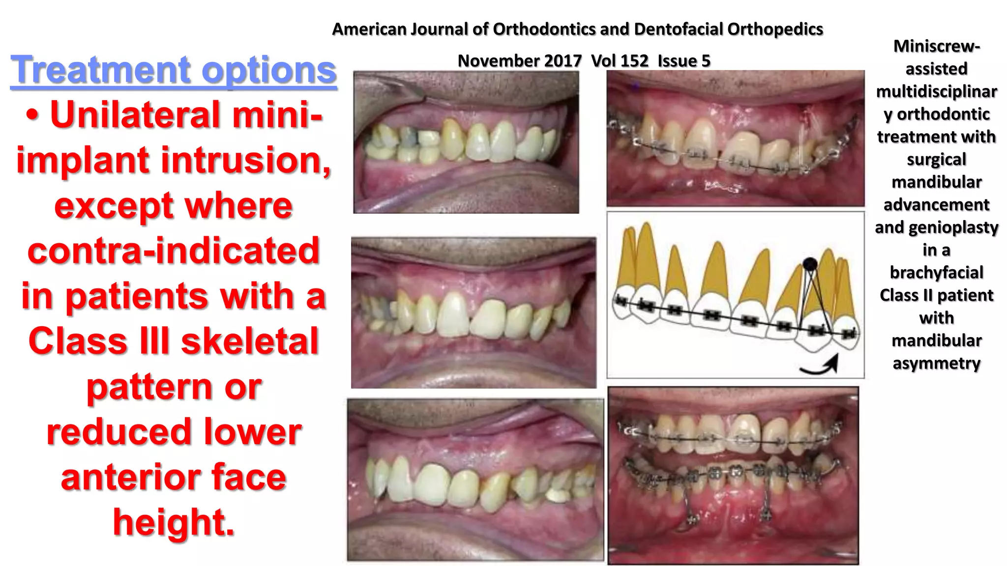 orthodontic correction of canted occlusal plane part 2 | PPTX