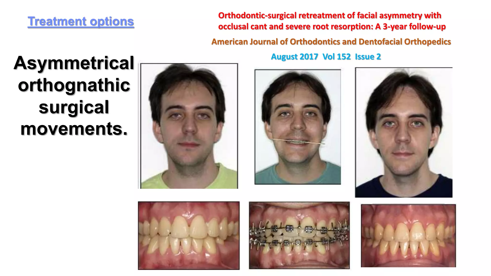 orthodontic correction of canted occlusal plane part 2 | PPTX