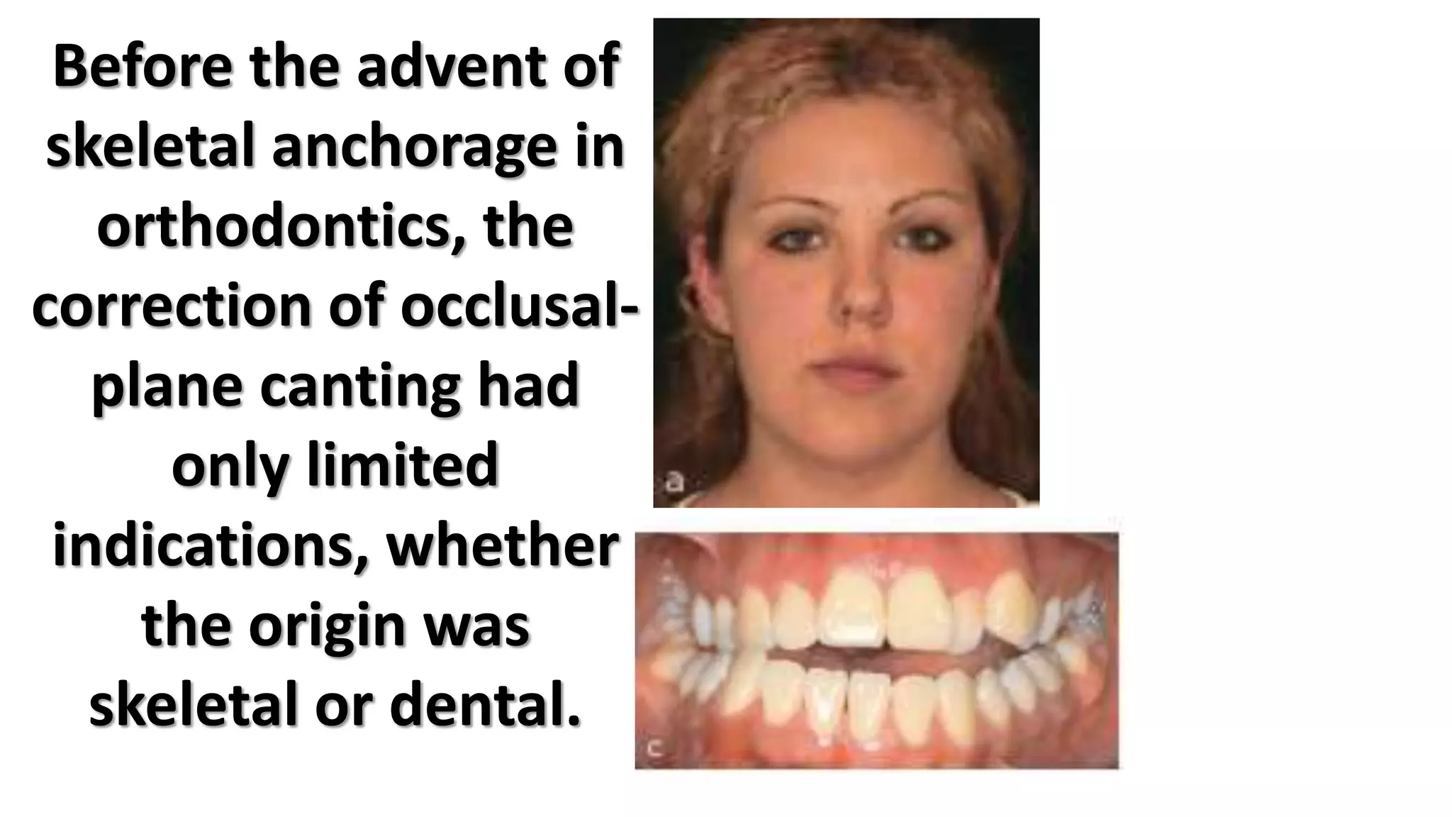 orthodontic correction of canted occlusal plane part 2 | PPTX