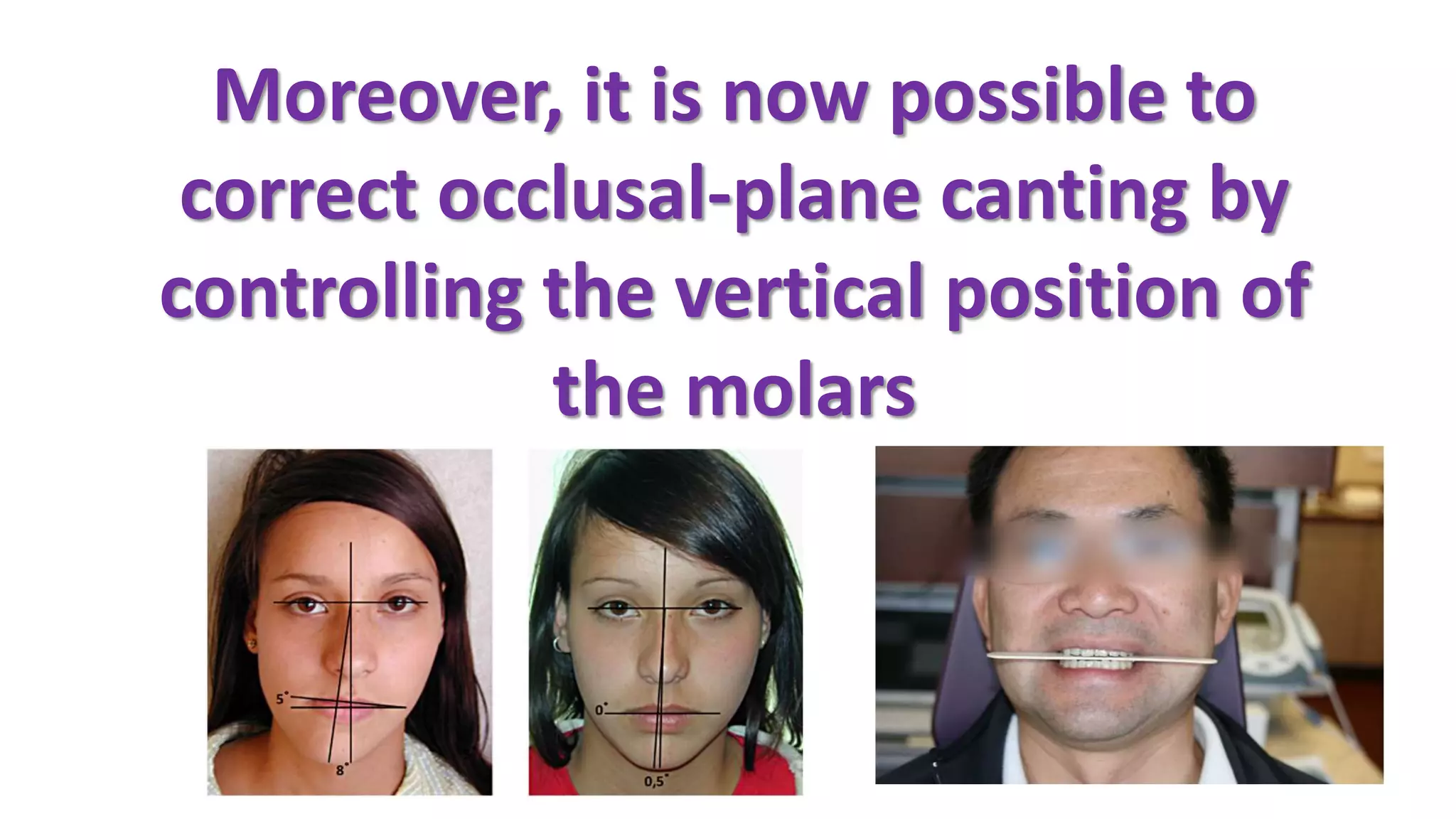 orthodontic correction of canted occlusal plane part 2 | PPTX