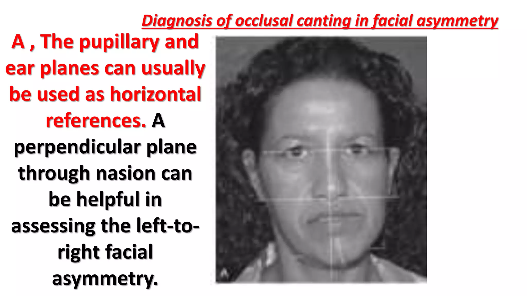 orthodontic correction of canted occlusal plane part 2 | PPTX