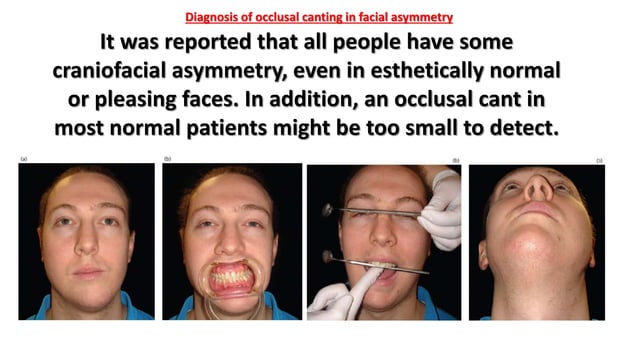 orthodontic correction of canted occlusal plane part 2 | PPTX