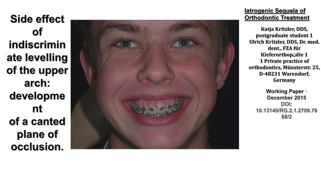 orthodontic correction of canted occlusal plane part 2 | PPTX