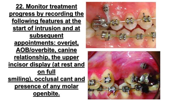 orthodontic correction of canted occlusal plane part 2
