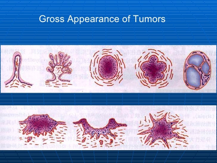 2 pathological diagnosis of cancer
