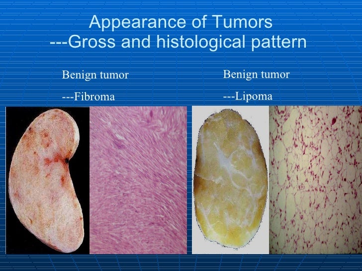 2 pathological diagnosis of cancer