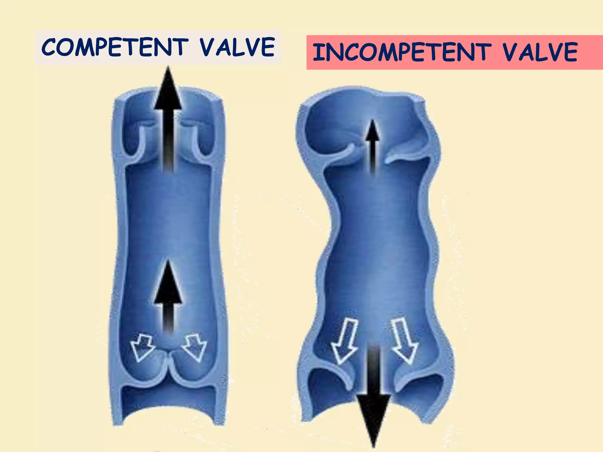 PATHOPHYSIOLOGY OF VARICOSE VEINS | PPTX