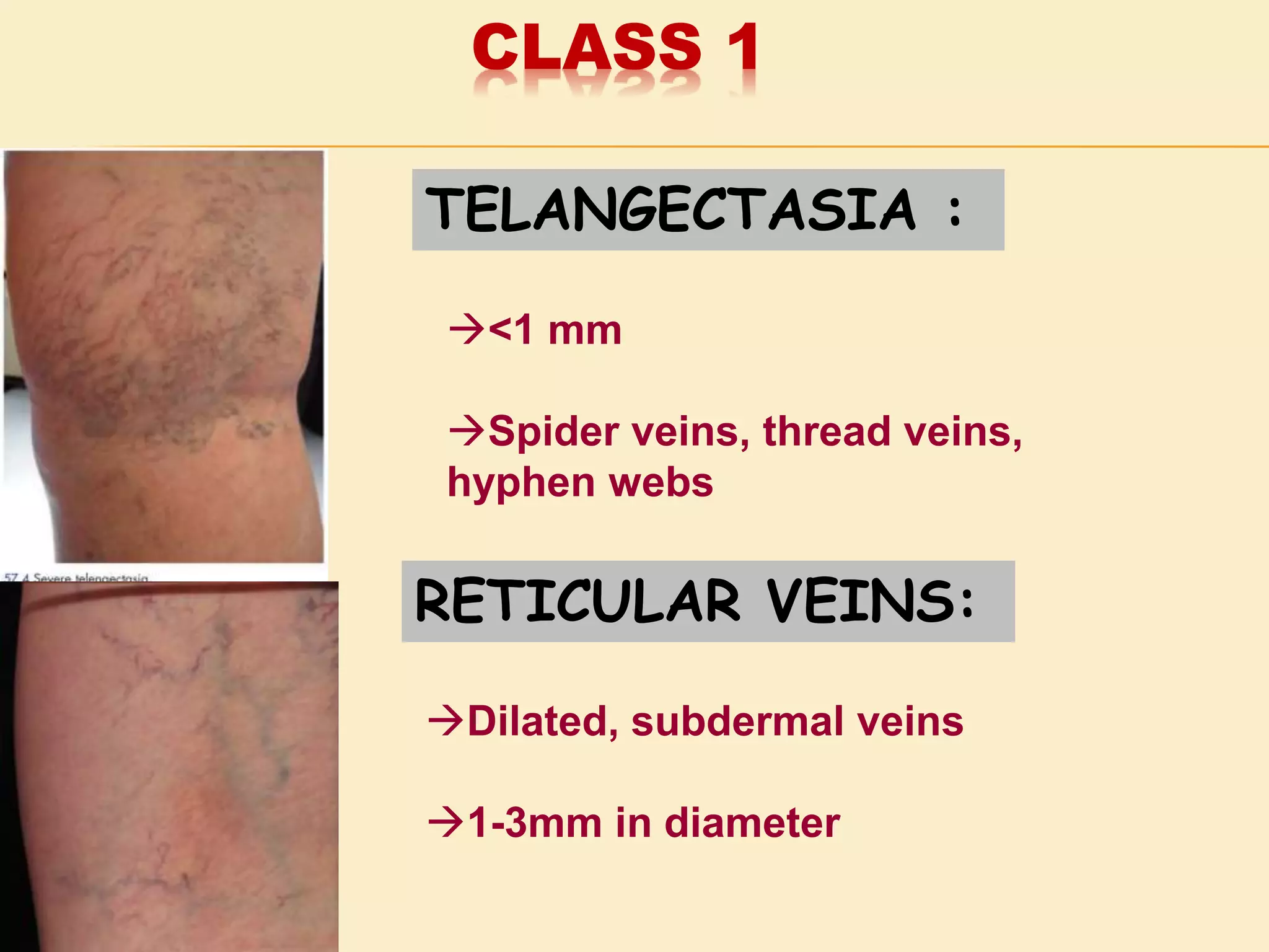 PATHOPHYSIOLOGY OF VARICOSE VEINS | PPTX