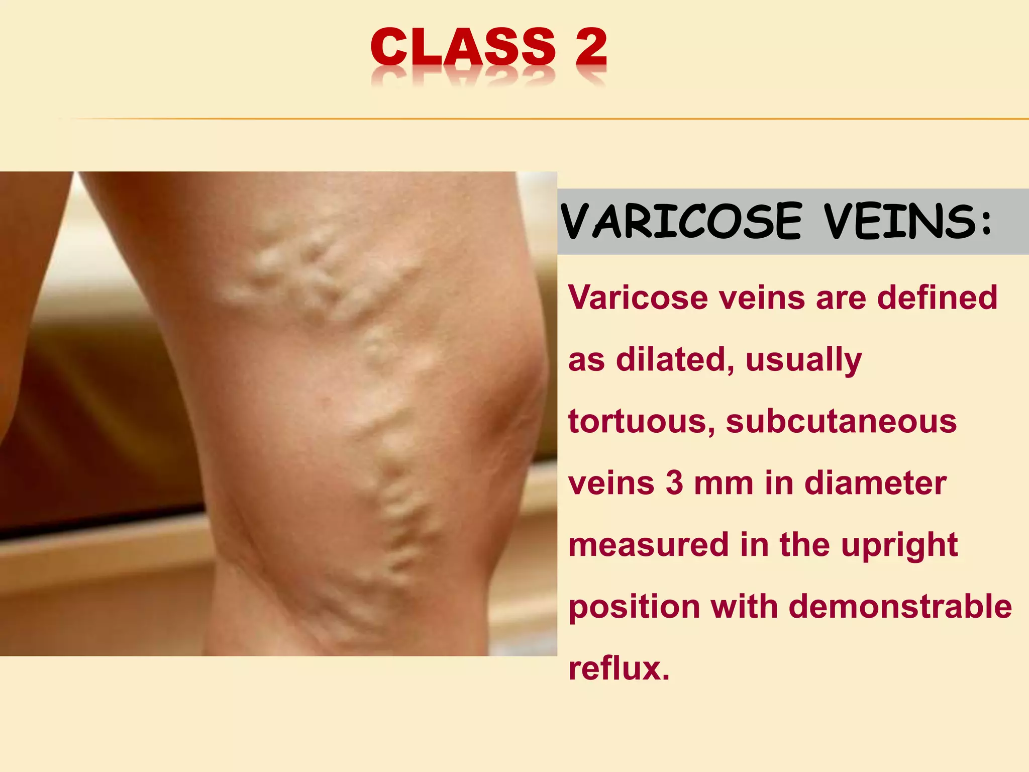 PATHOPHYSIOLOGY OF VARICOSE VEINS | PPTX