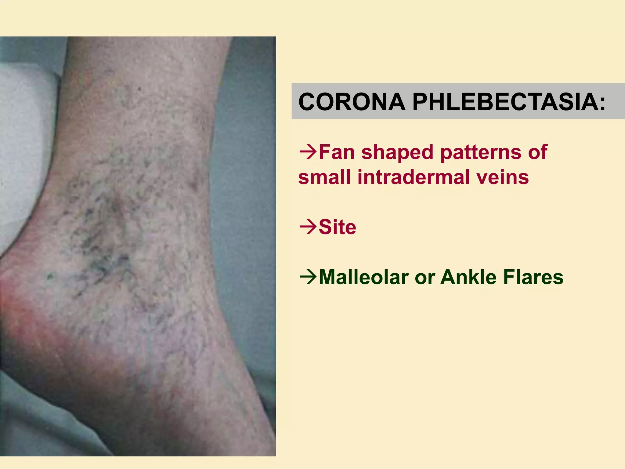 PATHOPHYSIOLOGY OF VARICOSE VEINS | PPTX