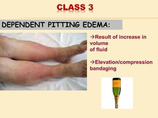 PATHOPHYSIOLOGY OF VARICOSE VEINS | PPTX