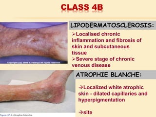 PATHOPHYSIOLOGY OF VARICOSE VEINS | PPTX