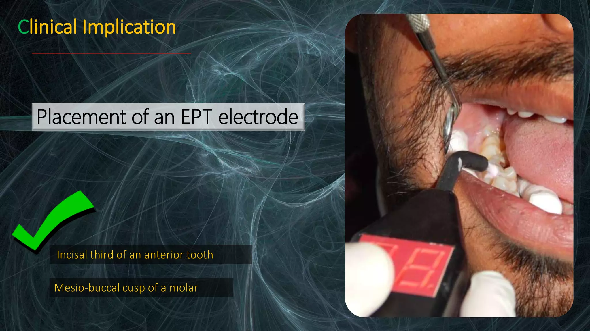 Dental pain (Irreversible pulpitis: Pathophysiology) | PPTX