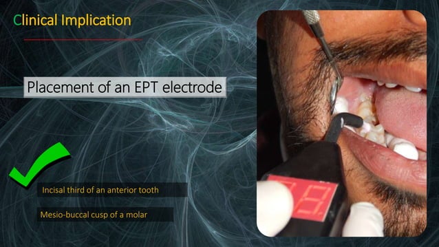 Dental pain (Irreversible pulpitis: Pathophysiology) | PPTX