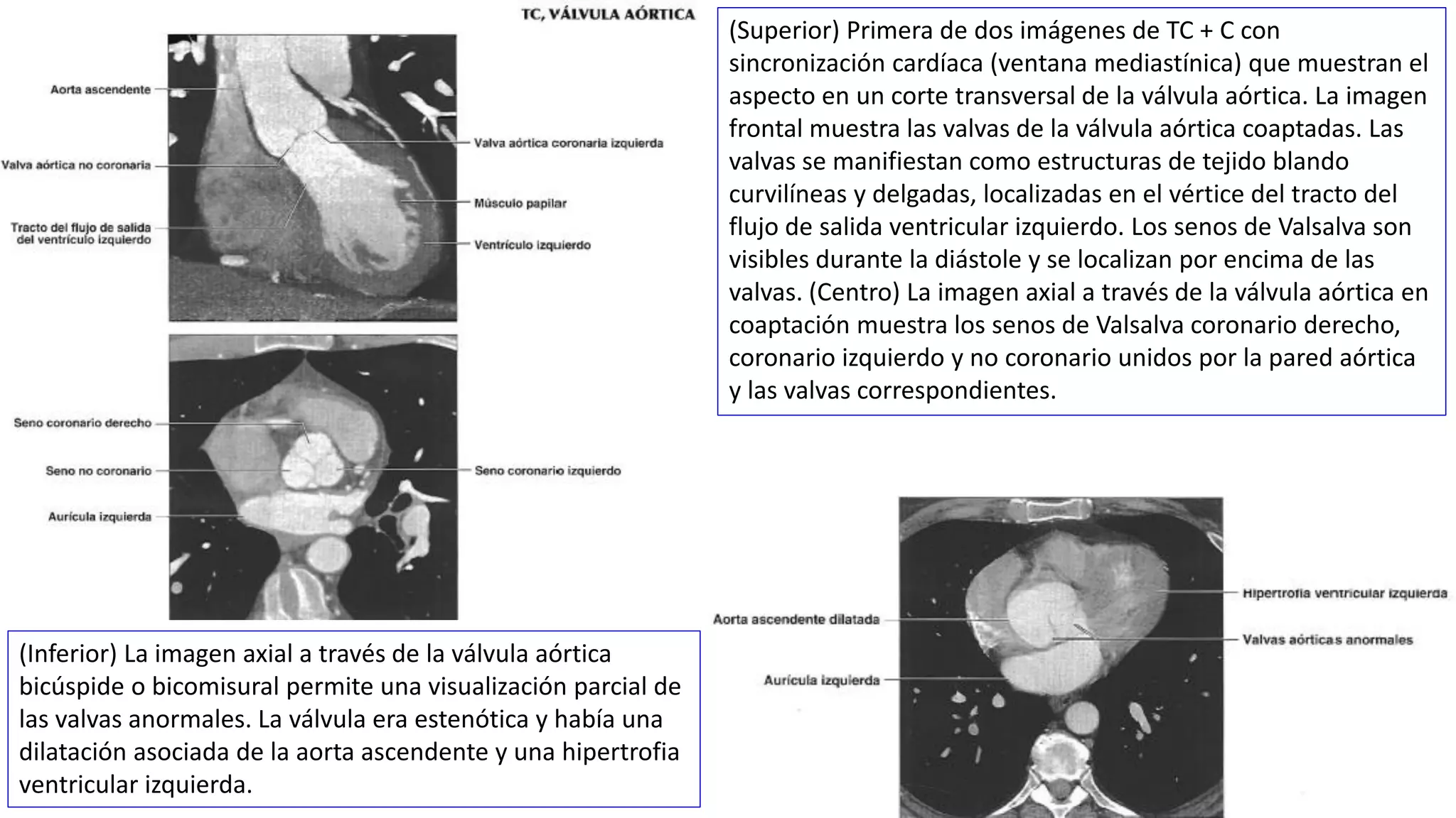 patologia rx tc rmn semiologia corazon art pulmonar y aorta | PPT