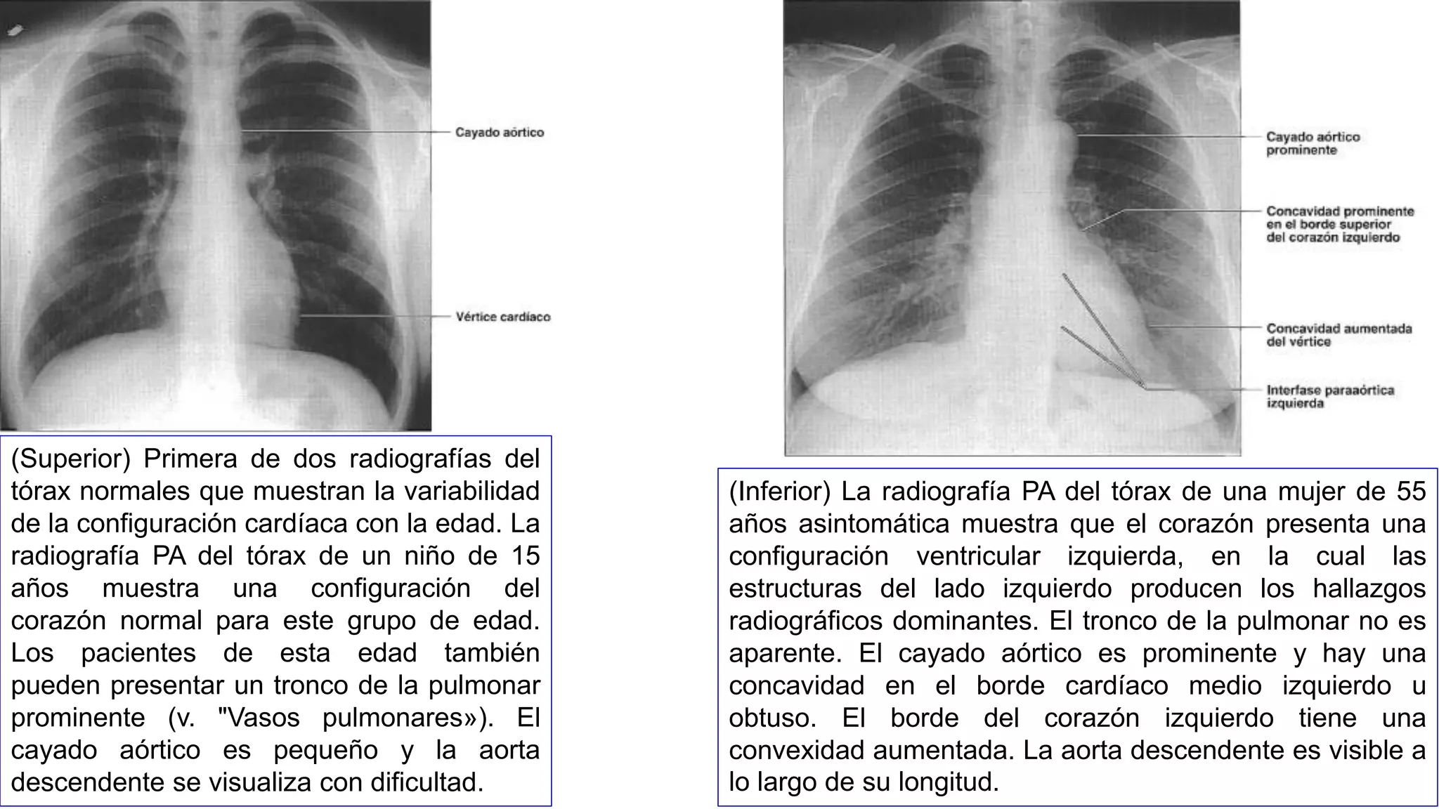 patologia rx tc rmn semiologia corazon art pulmonar y aorta | PPT