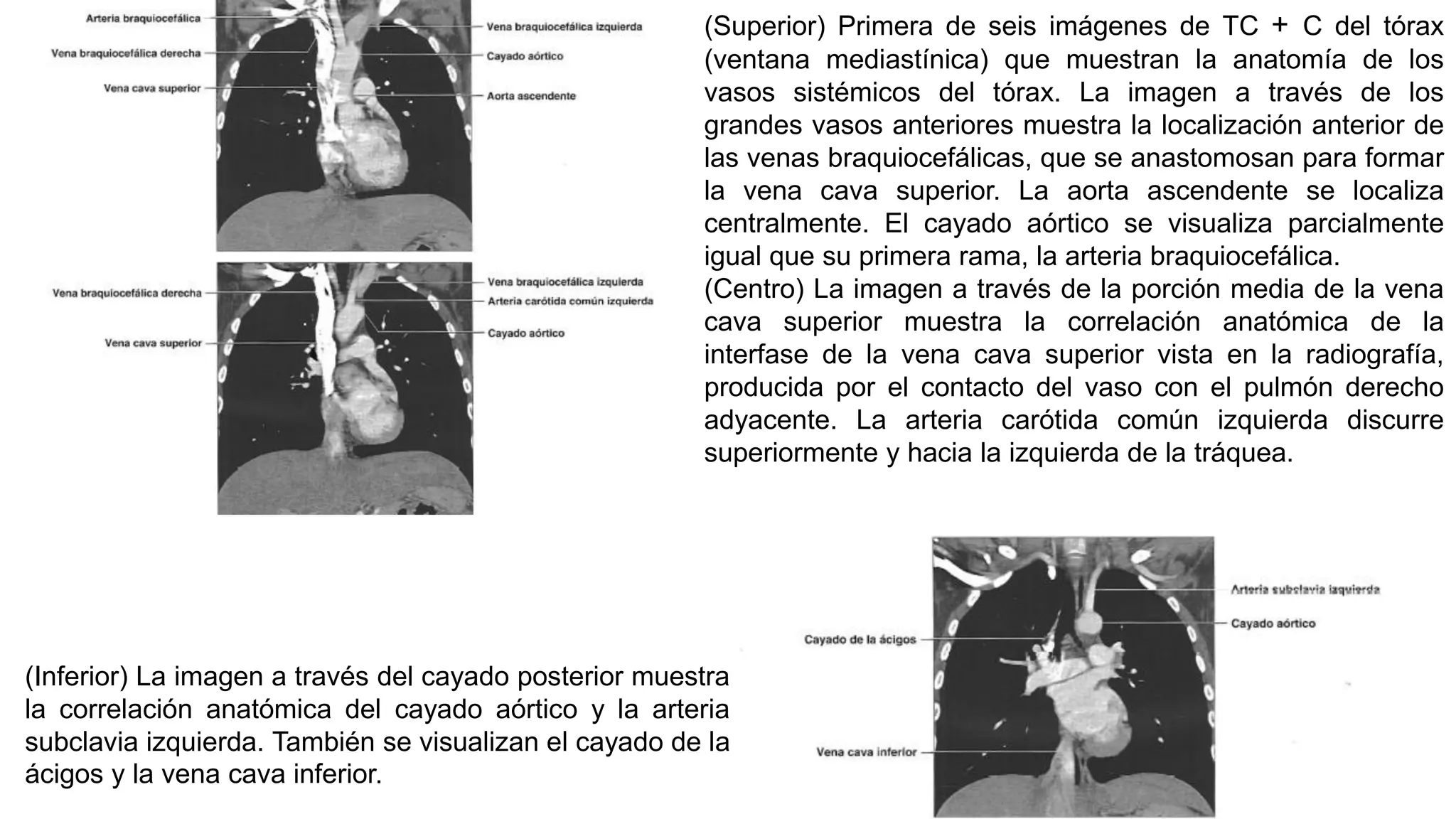 patologia rx tc rmn semiologia corazon art pulmonar y aorta | PPT