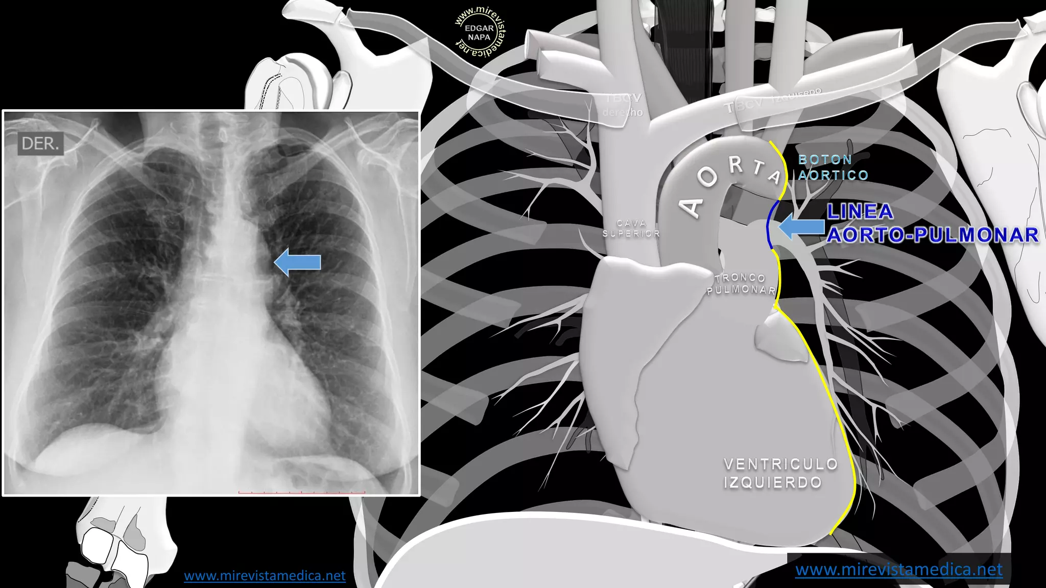 patologia rx tc rmn semiologia corazon art pulmonar y aorta | PPT
