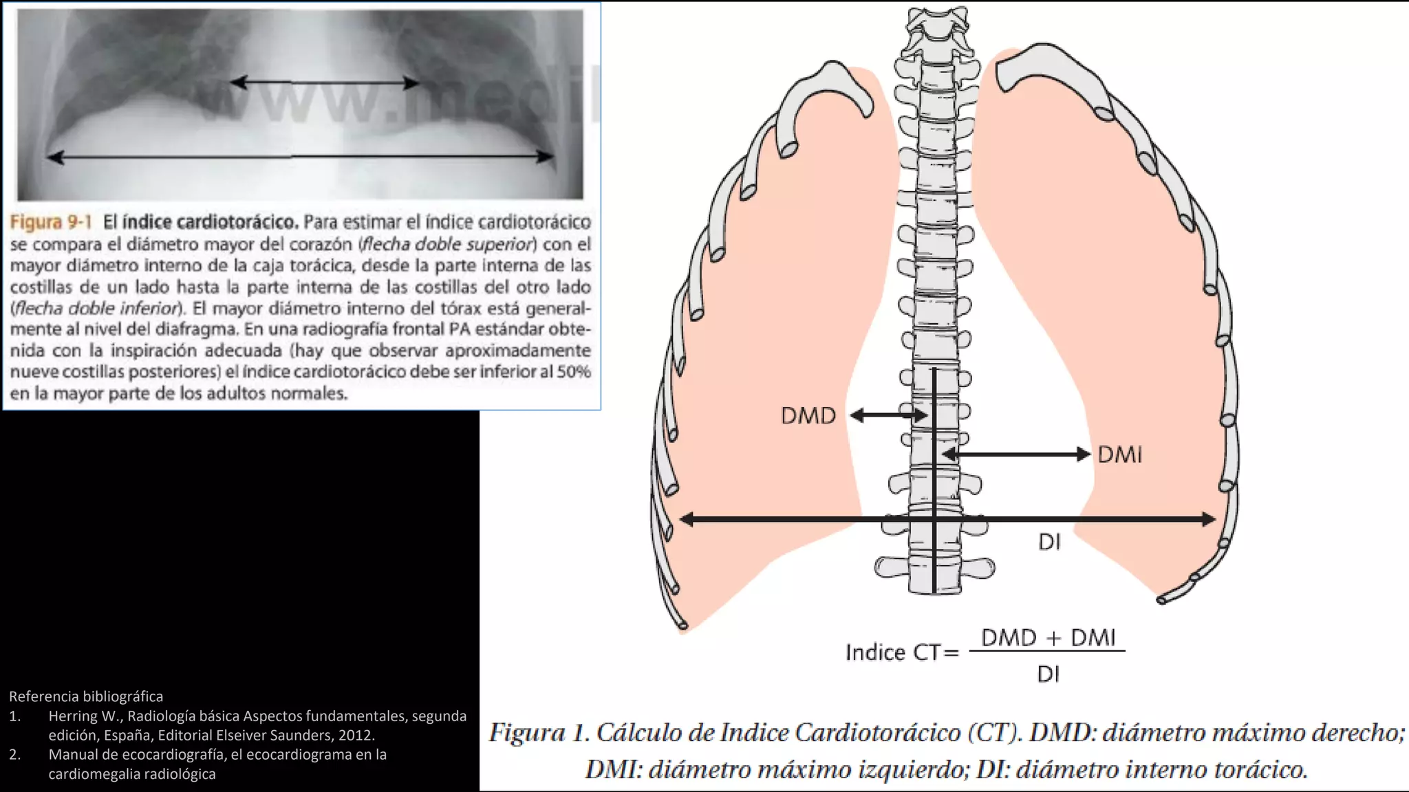 patologia rx tc rmn semiologia corazon art pulmonar y aorta | PPT
